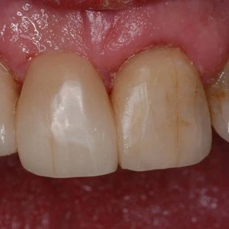 Ribbond splinted bridge with 5 year follow up – Drecomposite