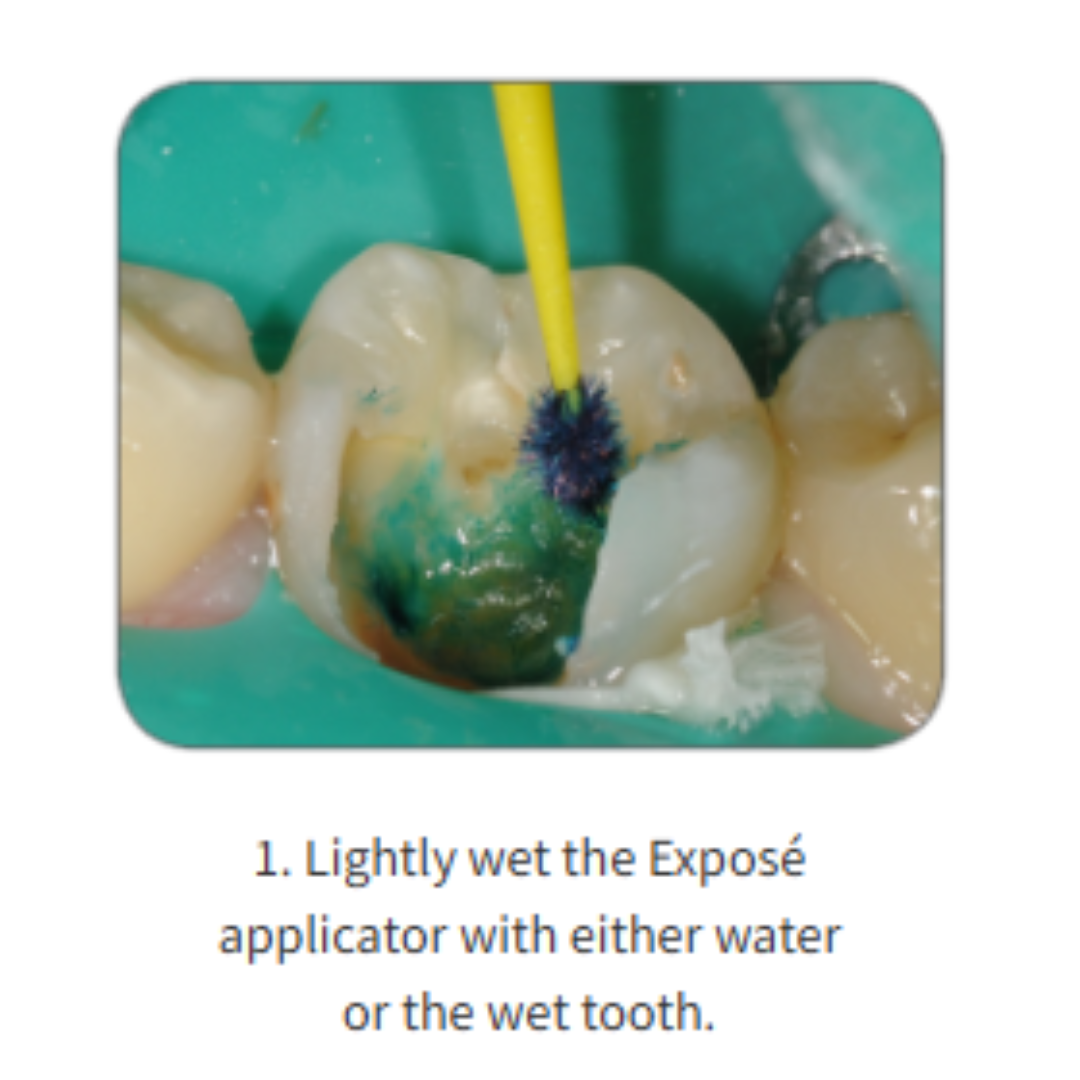 Centrix® Exposé® Disposable Caries Indicator – Drecomposite